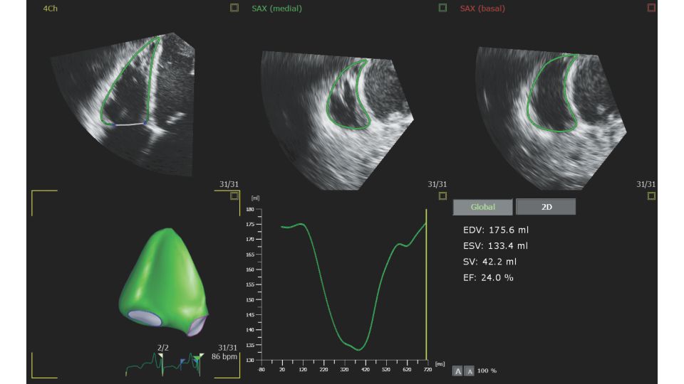 Philips Minicare cardiac troponin I (cTnI) point-of-care blood test ...