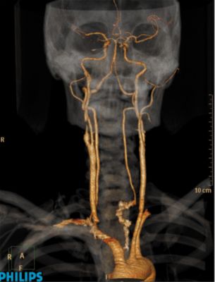 Multi Modality Advanced Vessel Analysis (AVA) | Philips