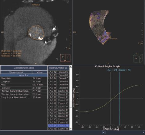 Ver detalles de Philips - CT TAVI Planning