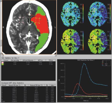 Afficher les détails de Philips - Perfusion cérébrale par scanner