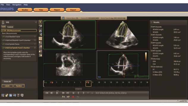 QLAB Ultrasound Cardiac Analysis | Philips Ultrasound