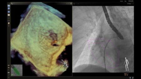 EchoNavigator Interventional tool; fusing live X-ray and live echo ...