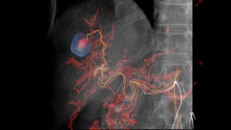 EmboGuide Workflow-based embolization guidance | Philips Healthcare