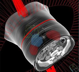 Philips Pinnacle³ SmartArc | Philips