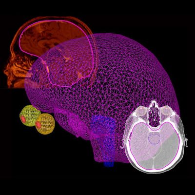 Pinnacle Model-Based Segmentation (MBS) | Philips Healthcare