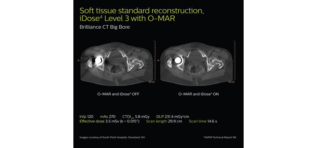 Philips Healthcare | Big Bore RT - CT scanner for radiation therapy and ...