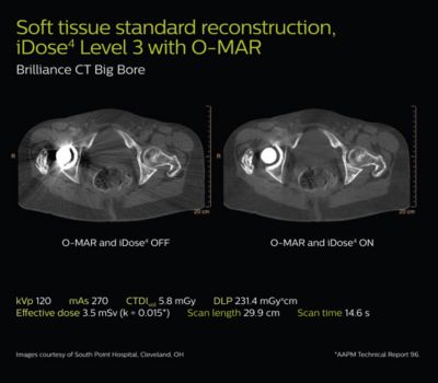 fonction O-MAR (Orthopedic Metal Artifact Reduction) | Scanner ...
