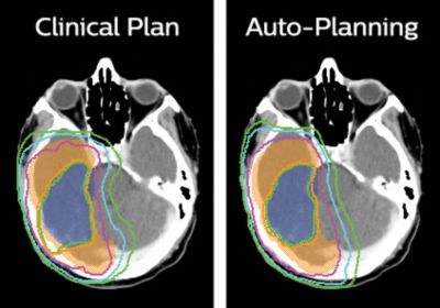 Philips Pinnacle³ 09.10 with Auto-Planning | Philips