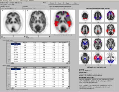 NeuroQ 3.0 Analyse-Tool für PET-Scans | Philips Healthcare
