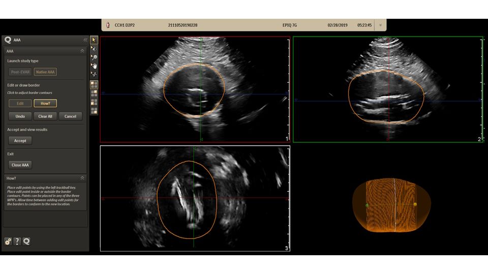 Philips Access CT, with a pediatric patient - Media library | Philips
