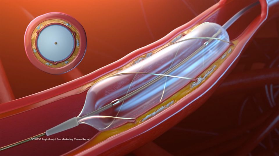 Real-time 3D Philips Intracardiac Echocardiography Catheter - Verisight ...