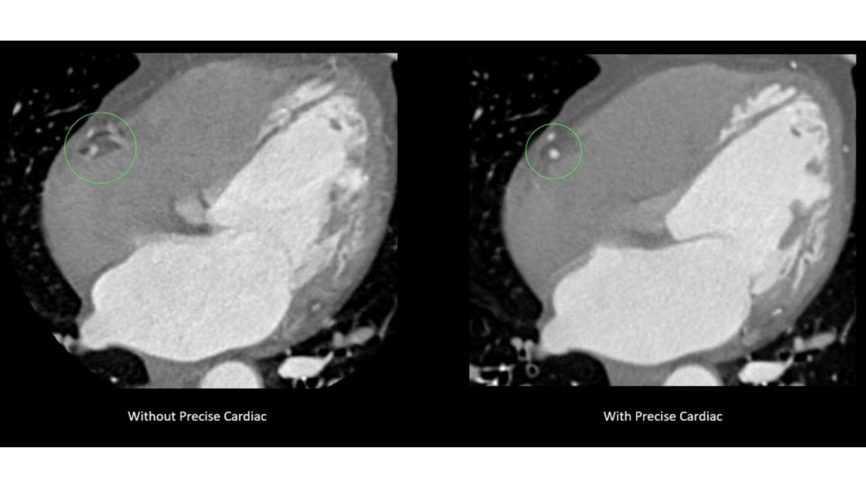 Patient preparing for a cardiac scan on the Philips Ingenia Ambition X MR system - Media library ...