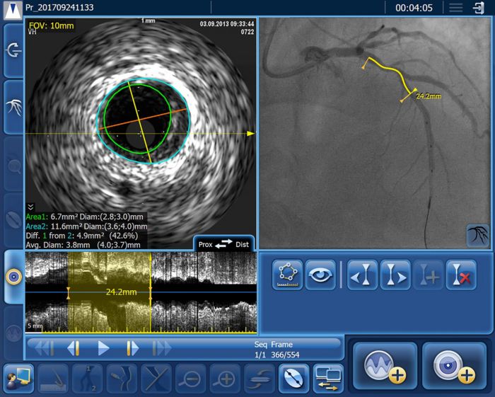 Philips Intravascular Ultrasound Ivus Media Library Philips