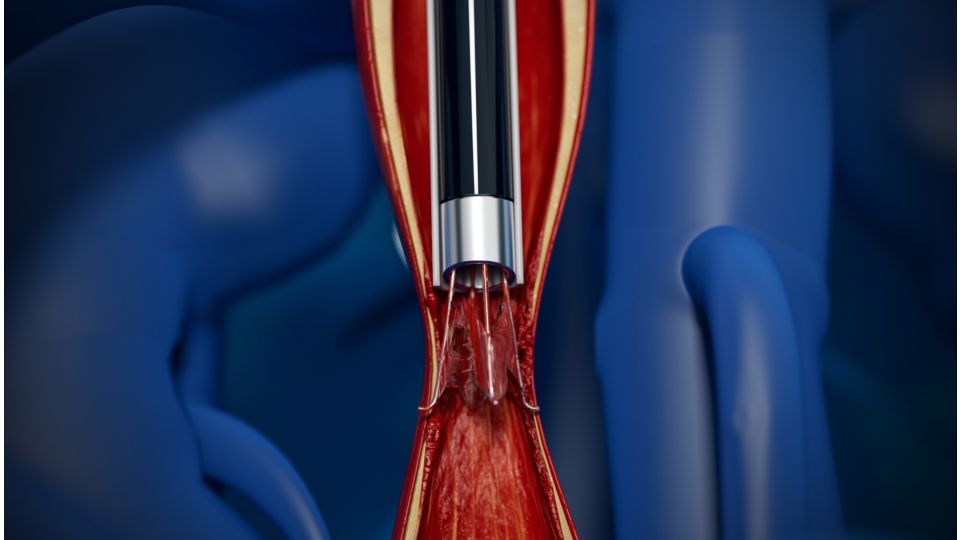 Philips QuickClear mechanical thrombectomy system - Media library | Philips