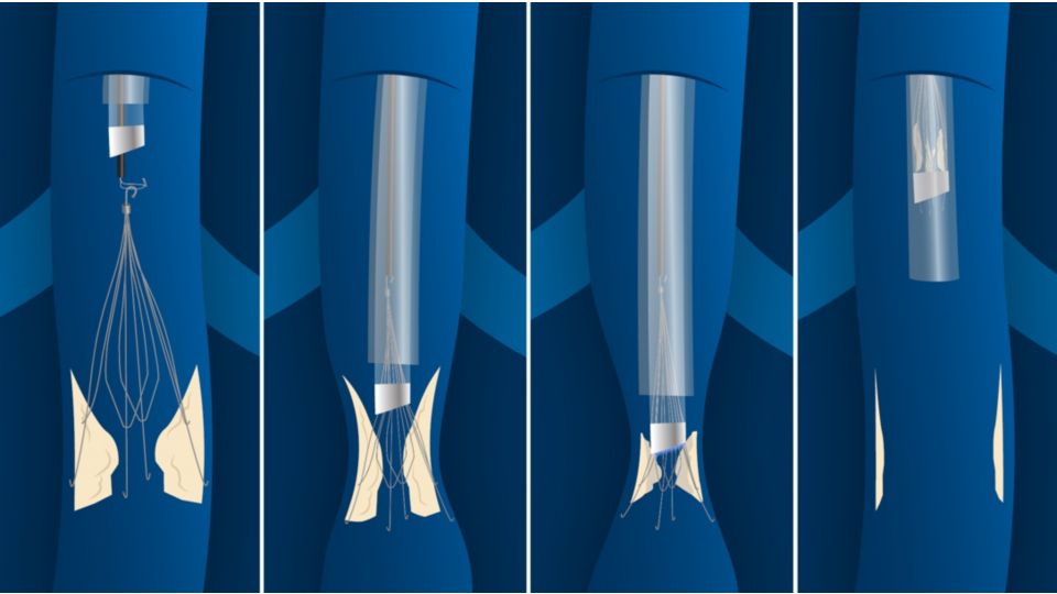 Philips QuickClear mechanical thrombectomy system - Media library | Philips