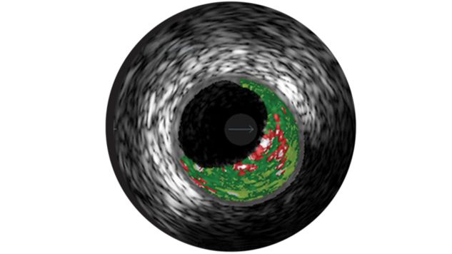Philips Volcano - Core Mobile Precision guided therapy system