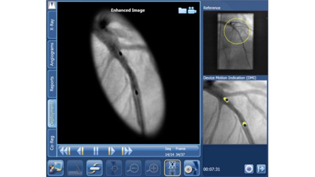Philips Volcano - SyncVision Precision guidance system