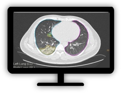 Philips - CT Pulmo Auto Results