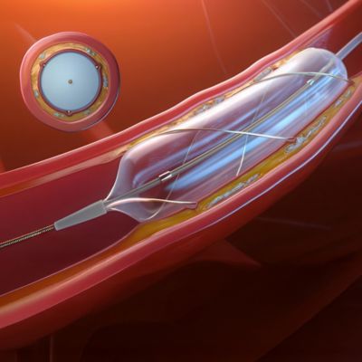 Specialty balloons - Philips