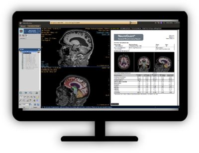 Philips - MR NeuroQuant Automated brain image analysis
