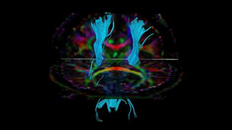 DTI FiberTrak MR Clinical application | Philips Healthcare