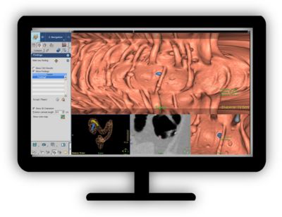 Philips - CT Virtual Colonoscopy