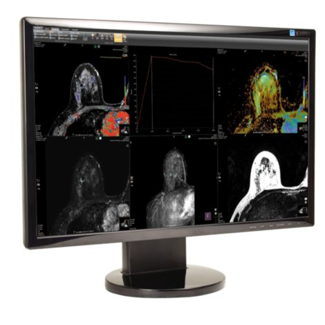 DynaCAD Breast Advanced visualization for breast MRI analysis | Philips ...