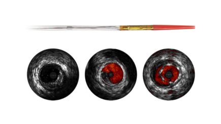 Philips Volcano - Eagle Eye Platinum Digital IVUS catheter