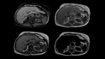 Compressed SENSE Abdomen | Philips