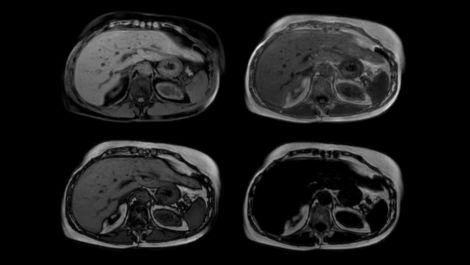 Compressed SENSE Abdomen MR Clinical Applications | Philips Healthcare