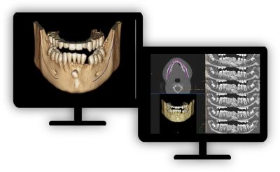 Philips - CT Dental Planning Planning for oral procedures
