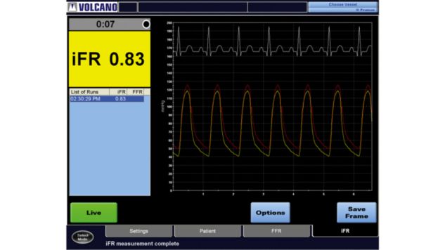 Philips Volcano - Core Mobile Precision guided therapy system