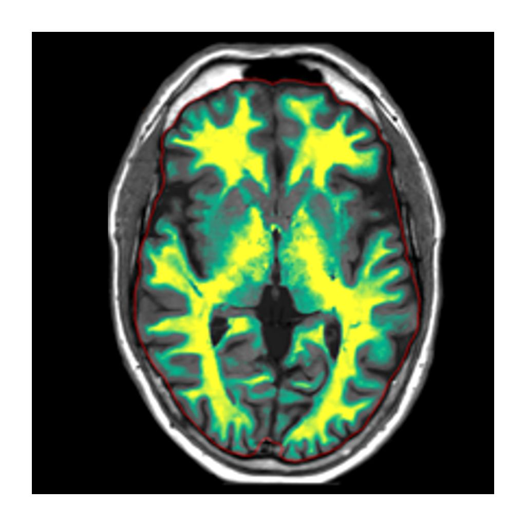 SmartSpeed Precise Dual AI – Philips