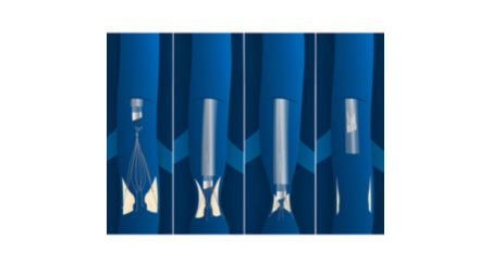 CavaClear – Philips IVC Filter Removal Laser Sheath | Philips Healthcare