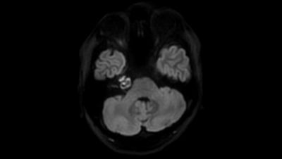 Philips - DWI XD TSE - Brain MR clinical application