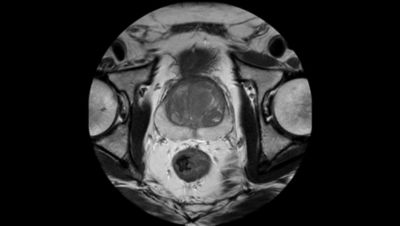 Philips - MultiVane XD - Pelvis MR clinical application