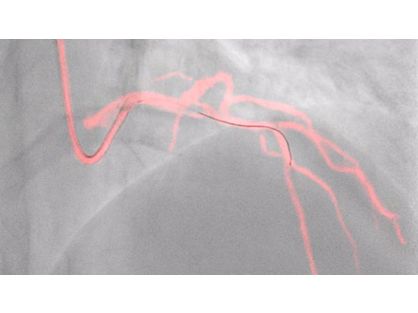 Philips - Dynamic Coronary Roadmap See clearly, guide confidently