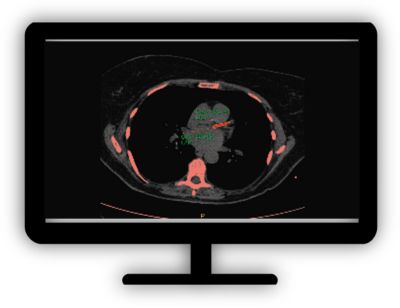 Philips - CT Calcium Scoring One-click 3D calcium segmentation