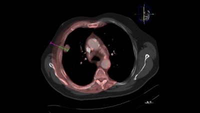 Philips - XperGuide - Live 3D needle guidance