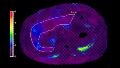 Philips - MR Elastography MR clinical application