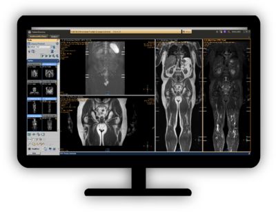 Philips - MR MobiView Automatic review of total body MR data