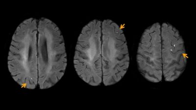 Philips - SmartSpeed Diffusion - Brain HCNMRF447E
