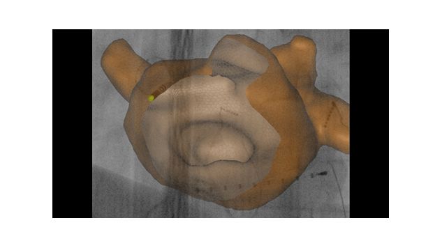 Philips - EP navigator Making the difference with Live Image Guidance