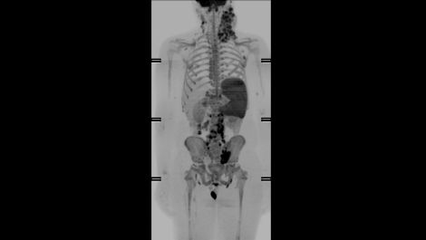 Philips - DWIBS - 全身 MRクリニカルアプリケーション