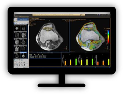 Philips - MR Cartilage Assessment Visualize cartilage structures鈥 ...