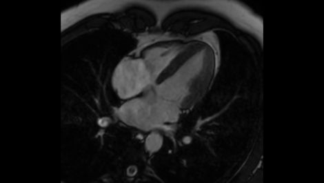 Compressed SENSE Cardiac MR Clinical Applications | Philips Healthcare