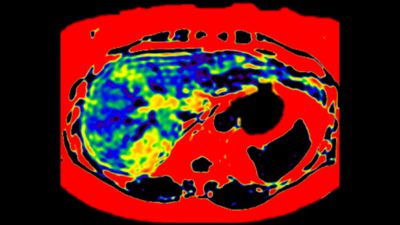 Philips - Smart Quant - Body HCNMRF449M MR Clinical Applications