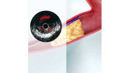 Philips - Pioneer Plus IVUS-guided re-entry catheter