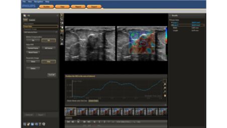 QLAB Cardiac Analysis Cardiovascular ultrasound quantification software ...
