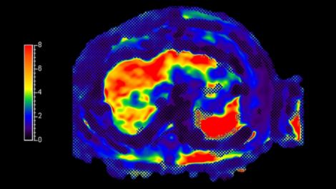 MR Elastography Extension MR clinical application | Philips